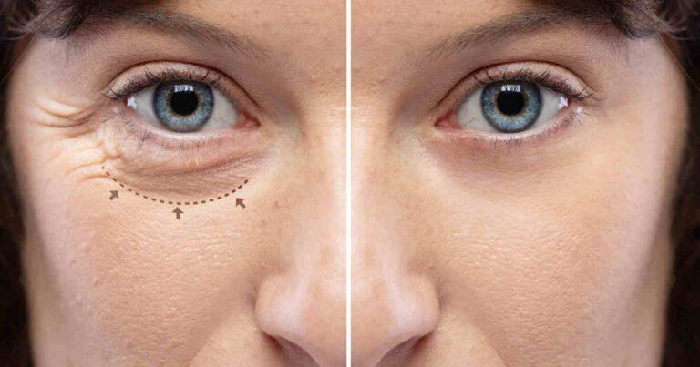 Non-surgical Blepharoplasty: What Is It And How Does It Works?