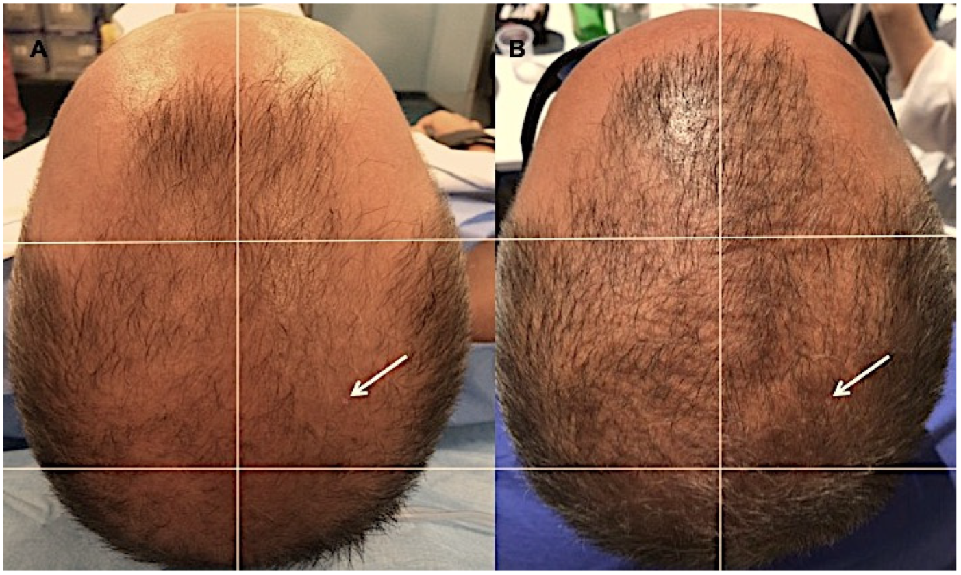 Learn About Micrograft Transplantation Techniques